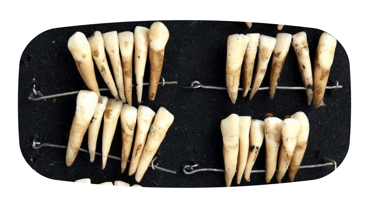 History of removable prosthesis and the 3 Major lines
