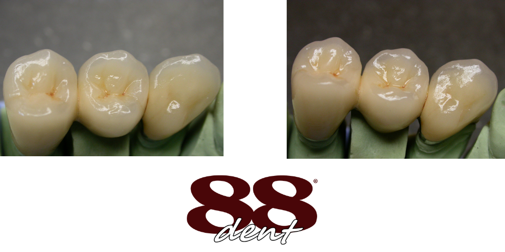 Leghe dentali manufatti protesici in metallo-ceramica